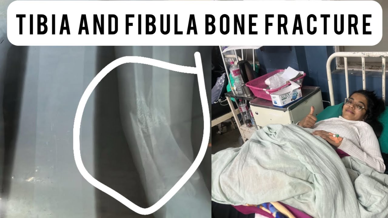 Tibia Fibula Bone Fracture [How I Broke My Leg?] - YouTube