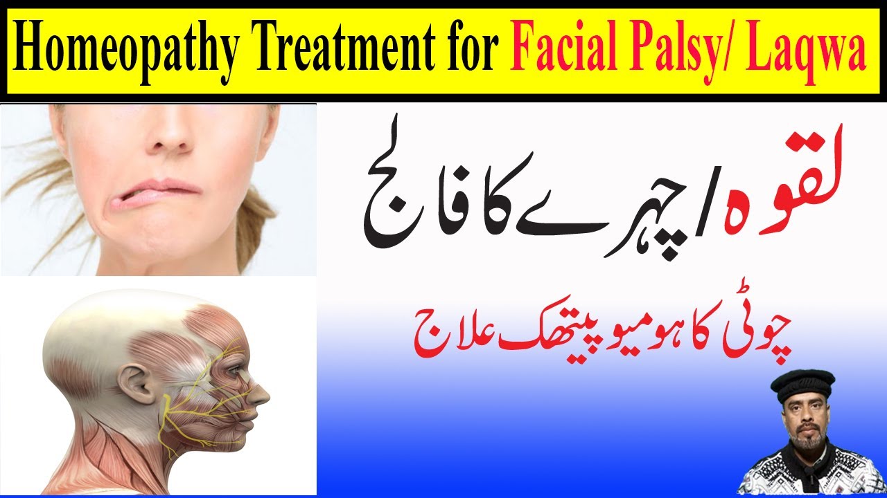 Laqwa ka Ilaj | Facial Palsy homeopathy treatment | Laqwa ka homeopathy ...