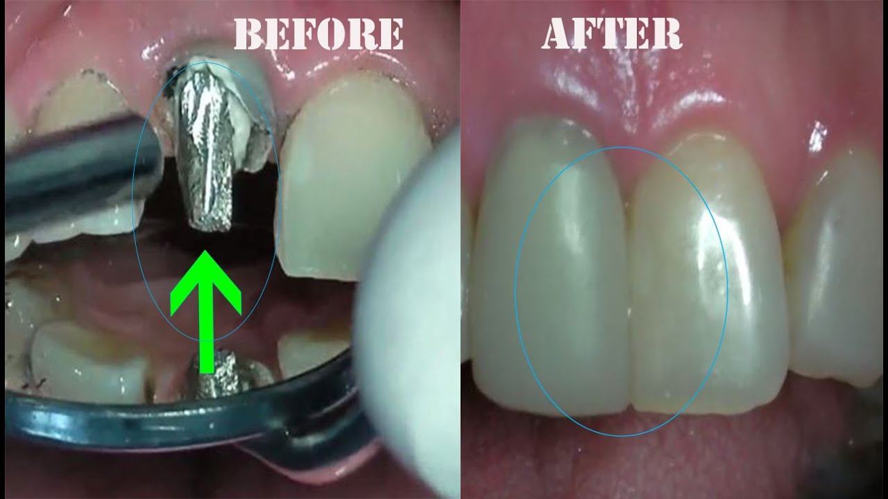 Dental treatment 2021 | How to repaired Tooth - YouTube