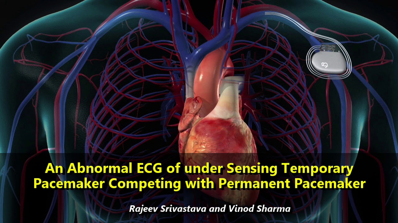 An Abnormal ECG of under Sensing Temporary Pacemaker Competing with ...