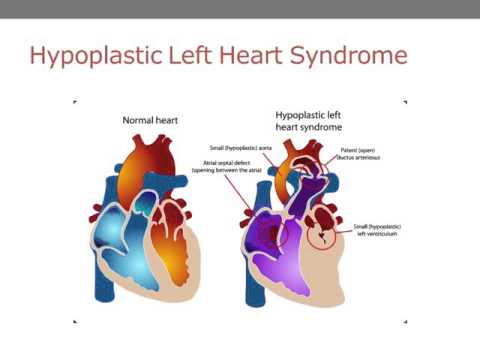 What is a Fontan Repair? - YouTube