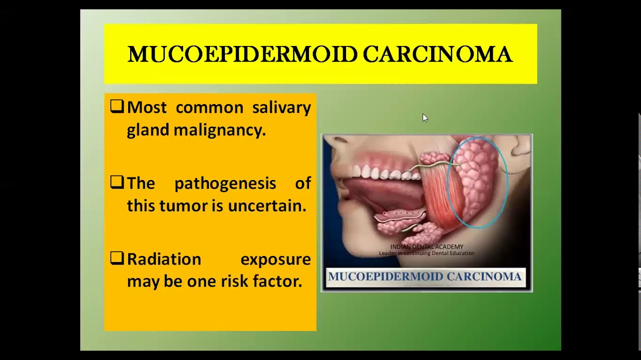 Salivary gland malignant tumors - YouTube