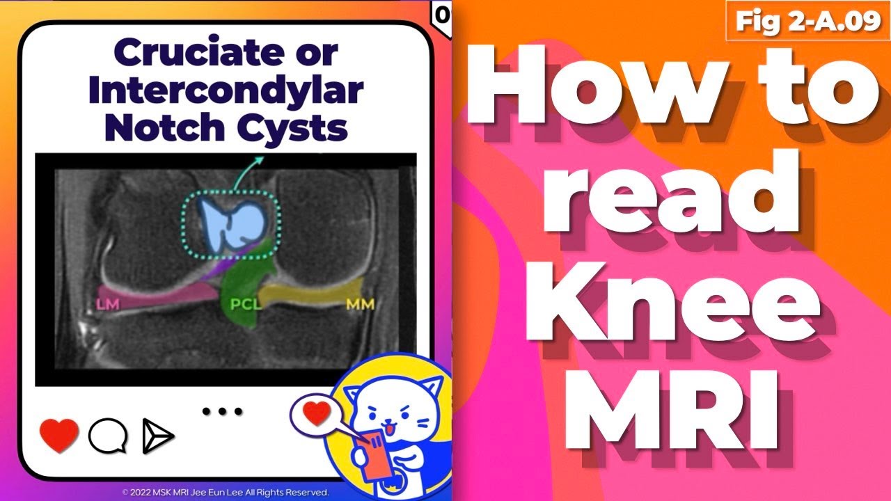 (Fig 2-A.09) Cruciate or Intercondylar notch cysts, ACL ganglion cyst ...