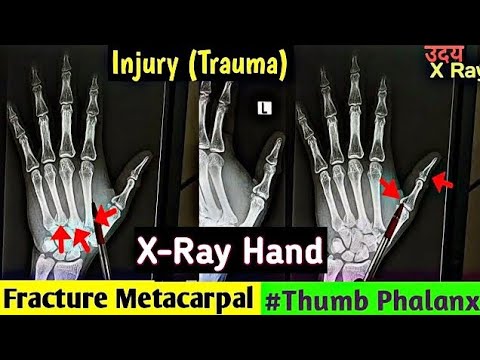 Hand Trauma X-Ray Finding | Multiple Fracture Metacarpal & Thumb | XRay ...