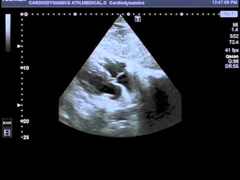 extracardiac mass - YouTube