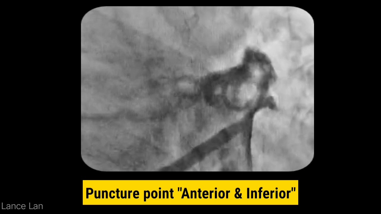 LAmbre LAAO Small Reverse Chicken Wing - YouTube