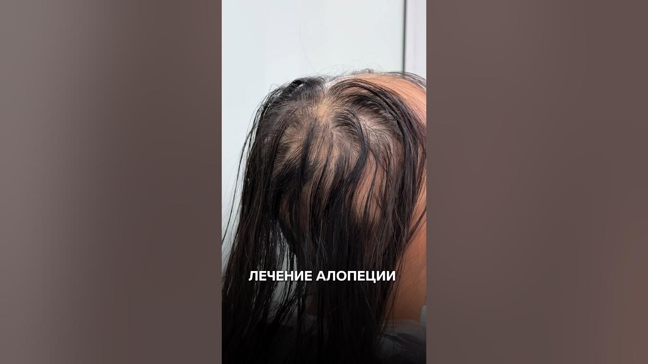 алопеция лечениеалопеции облысение выпаливолосы поредение
