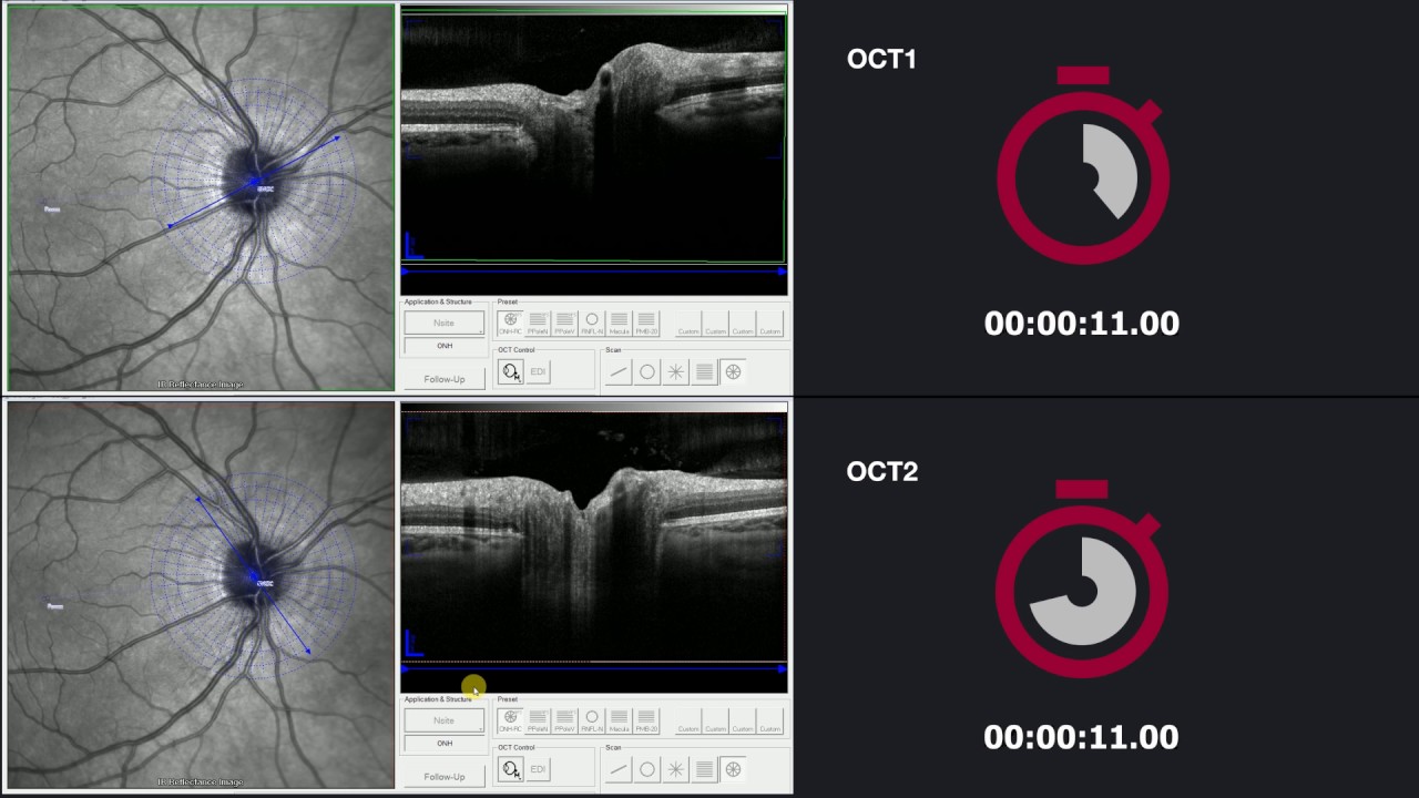 SPECTRALIS OCT vs OCT2 Module: Glaucoma Module Premium Edition - YouTube