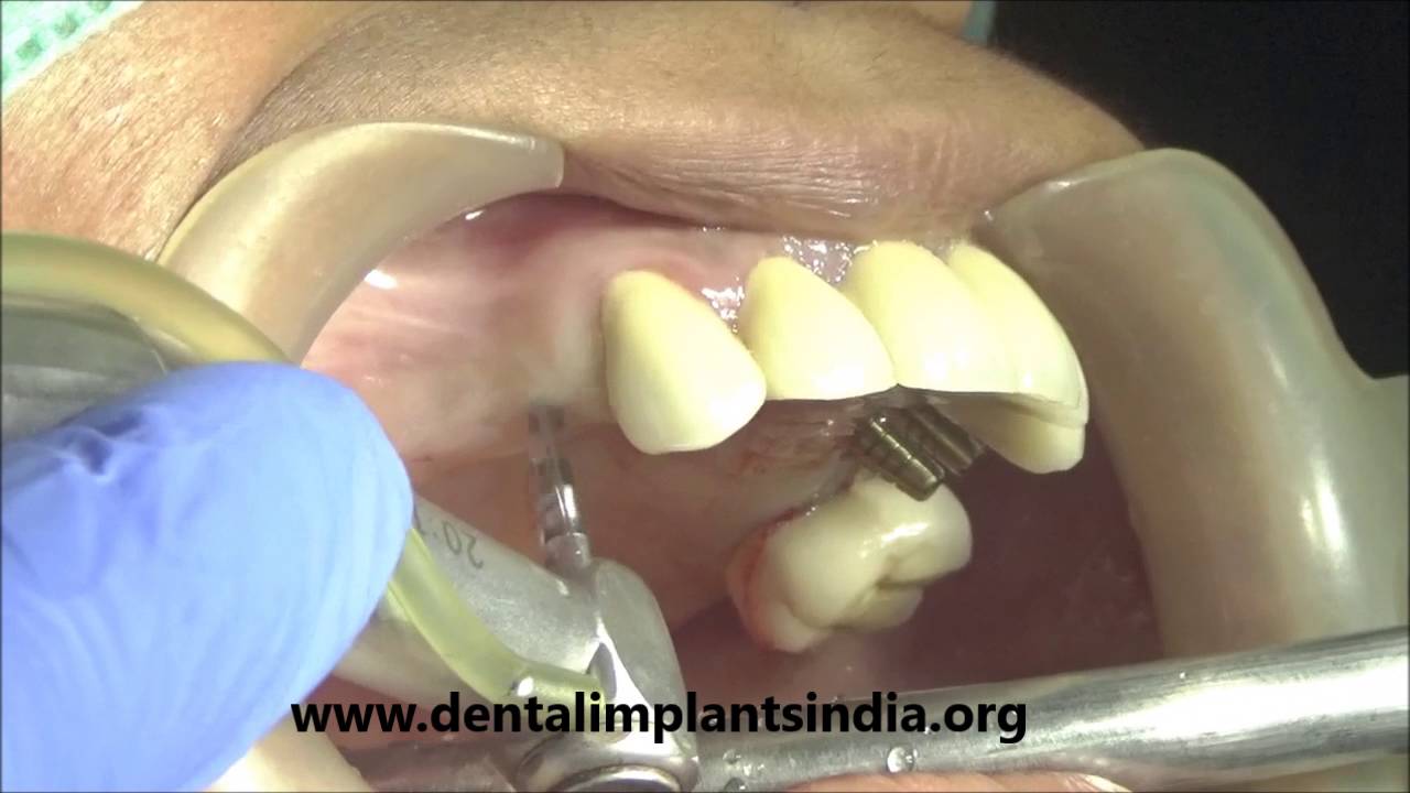 Lower full arch basal implants(genxt) surgery and upper molars-FULL ...