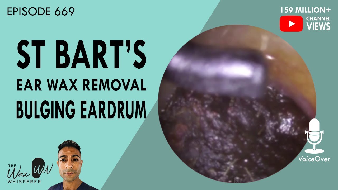 669 - St Bart's Ear Wax Removal Bulging Eardrum - YouTube