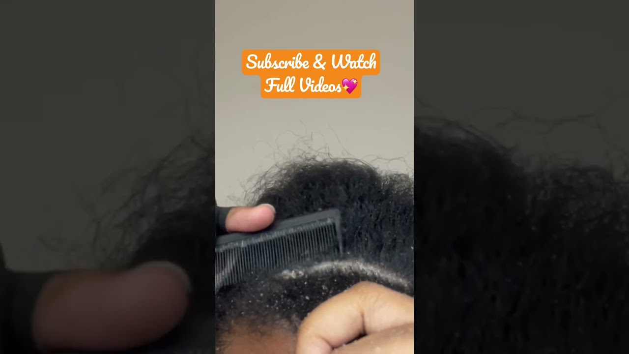 Dandruff Scratching Buildup | Huge Flakes and Lice (Bugs) Off Itchy Scalp #shorts #subscribe ...