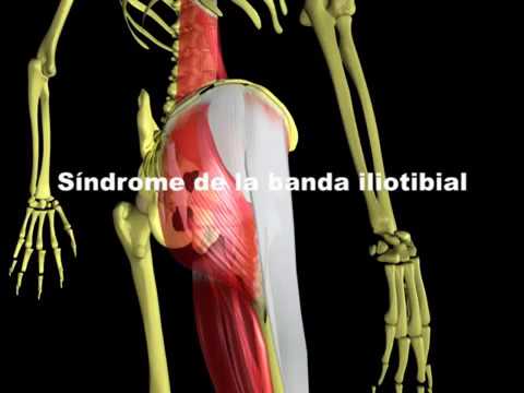 Síndrome de la banda iliotibial - YouTube