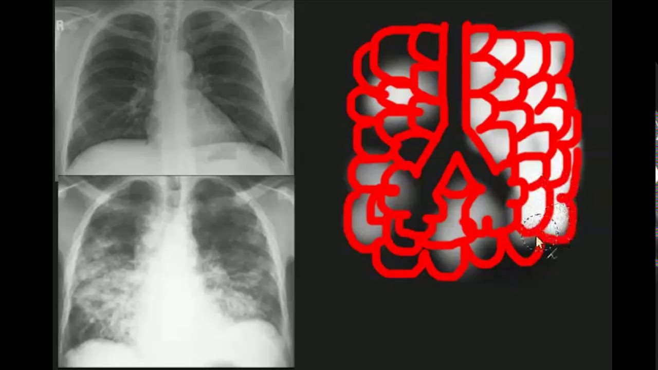 Opacidade Pulmonar Raio X - RETOEDU
