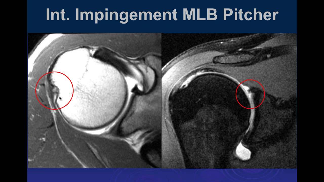 Shoulder | Impingement Pt 2 - YouTube