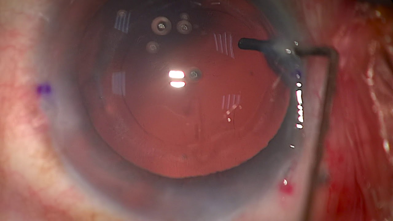 Hydropolish for residual cortex removal - YouTube