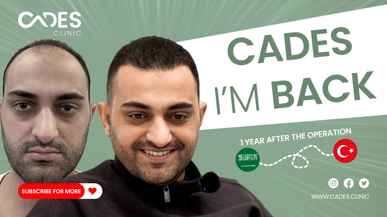 Hair Transplant After 1 Year: Don't Hesitate, Just Do it! | Cades I'm Back | Cades Clinic - YouTube