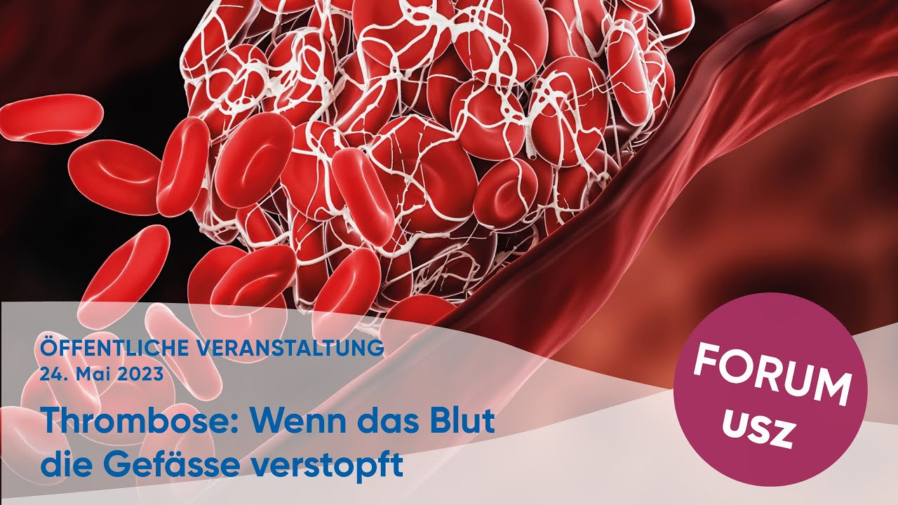 Forum – Thrombose: Wenn das Blut die Gefässe verstopft - YouTube