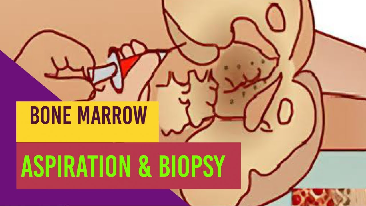 Bone marrow aspiration and biopsy/Process/Indications/Medschool ...