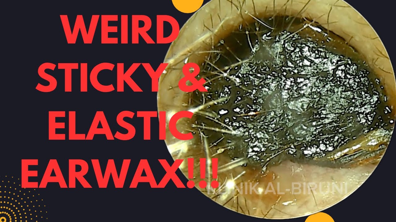Weird Sticky & Elastic Earwax Removed!!! - YouTube