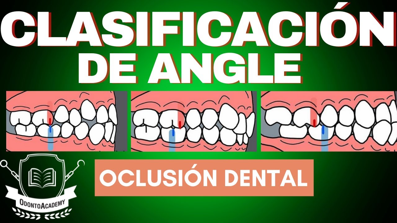 CLASIFICACIÓN DE LAS MALOCLUSIONES | CLASIFICACIÓN DE ANGLE | oclusión dental. - YouTube