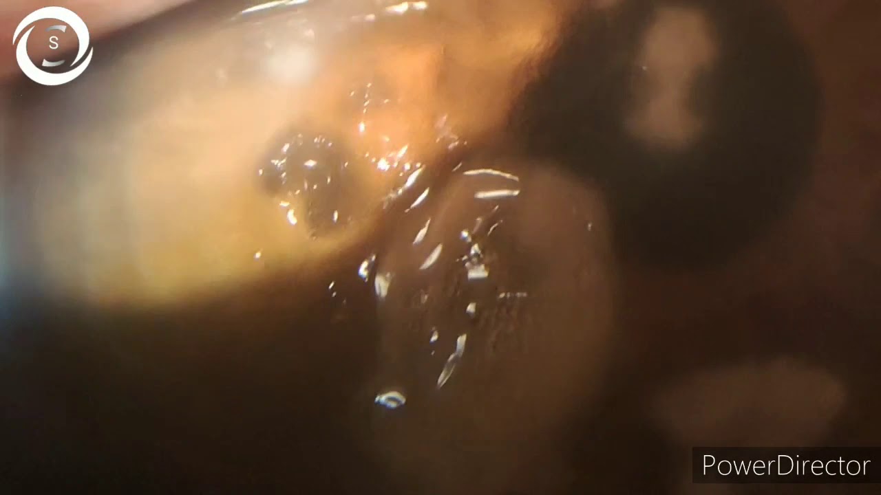 How to inject intrastromal antifungal injections - YouTube