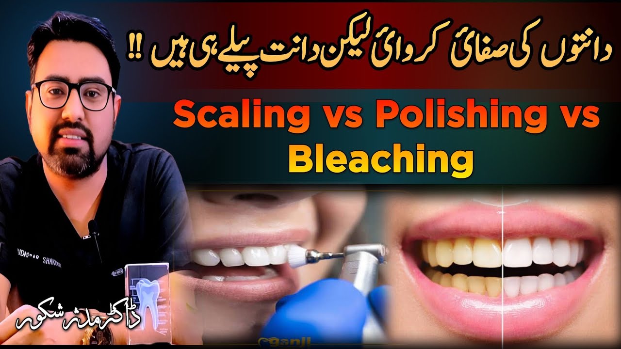 Dental scaling,vs Polishing vs Bleaching دانت صفائ کے باوجود پیلے کیوں ...