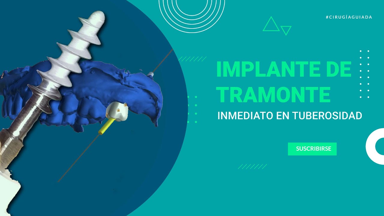 Implante de TRAMONTE inmediato en tuberosidad - YouTube