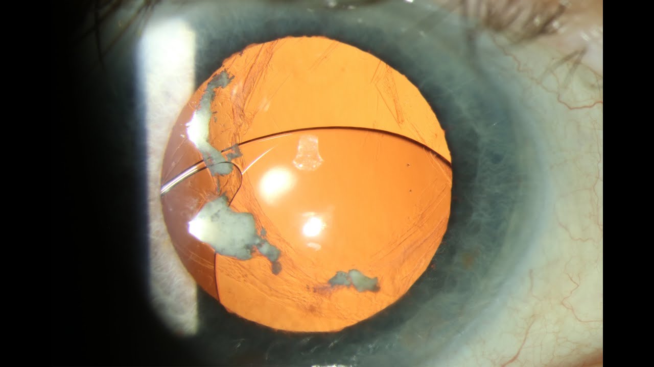 Scleral refixation of subluxated non-foldable PMMA IOL in highly myopic ...