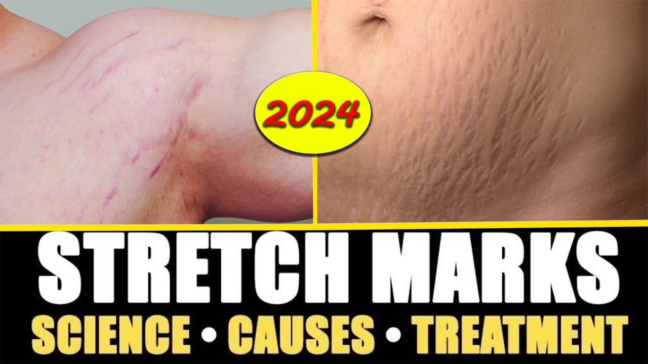 GOODBYE FOREVER - Stretch Marks | Stretch Marks Science, Causes ...