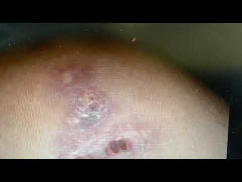 Tummy tuck complications, Dr Adam Rubinstein Miami Horrible Infectoin ...