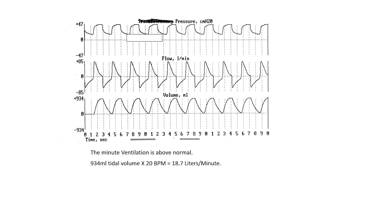 Exercises in ventilator waveform analysis -- exercise 1 - YouTube