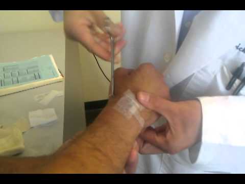 Pin removal from my wrist ligament sugery! - YouTube