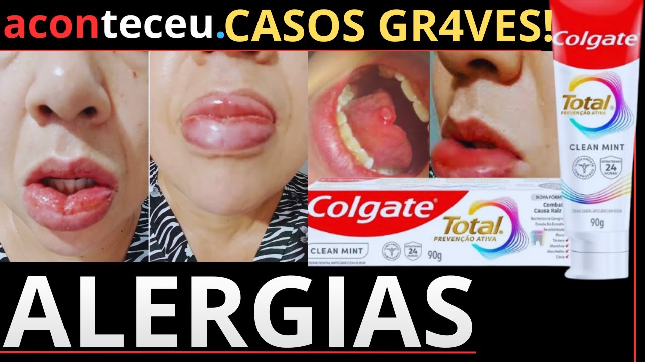 CREME DENTAL COLGATE TOTAL CLEAN MINT PROIBIDO PELA ANVISA APÓS ALERGIA ...