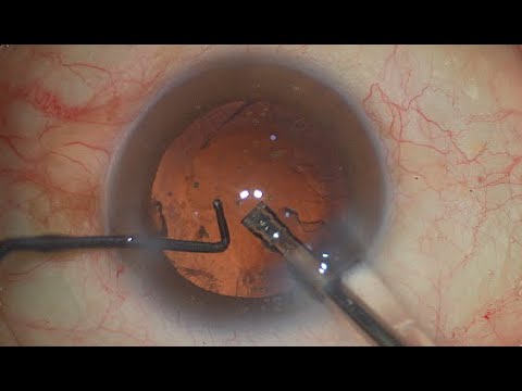 Phaco for Gummy Cataract | Haptic Flip, Air Bubble Behind IOL | Dr ...