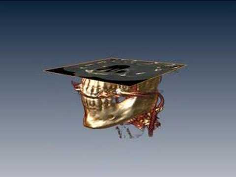 3D visualization of a head CT scan - YouTube