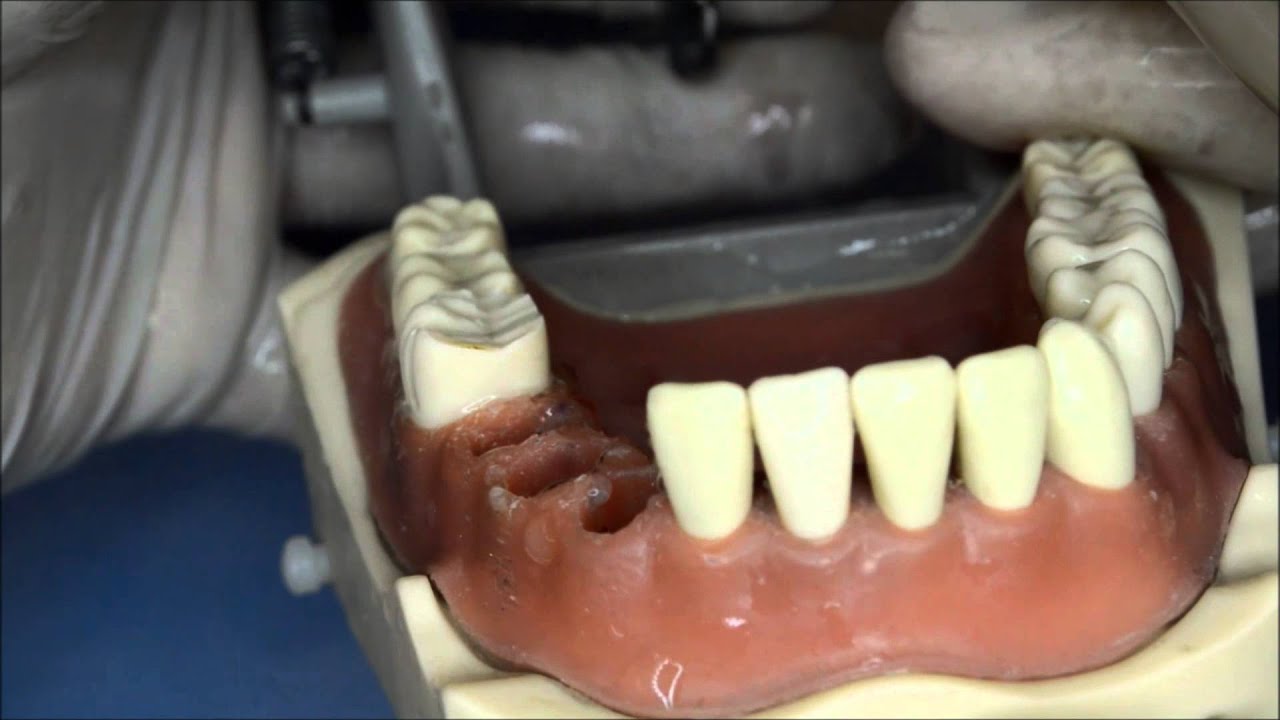 Tallado molar 46 parte 1 - YouTube