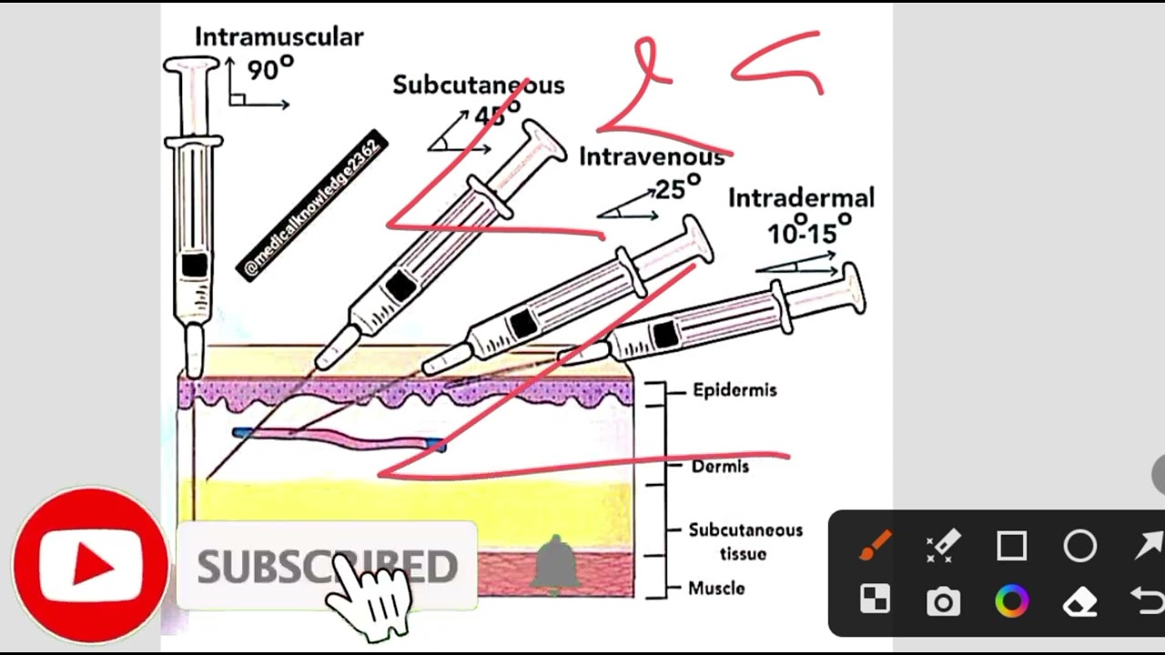 90 Degree Angle Injection