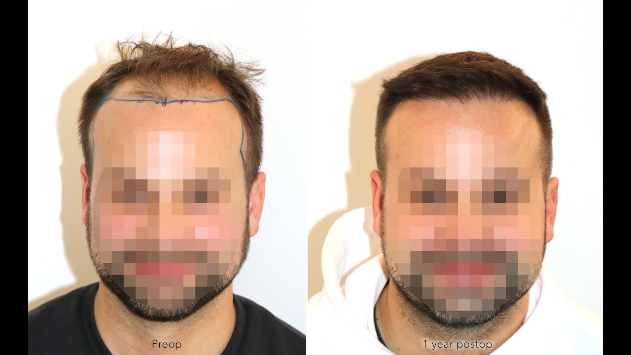 FUE Hair Transplantation Front Head, Hairline & Temple Points | Before ...