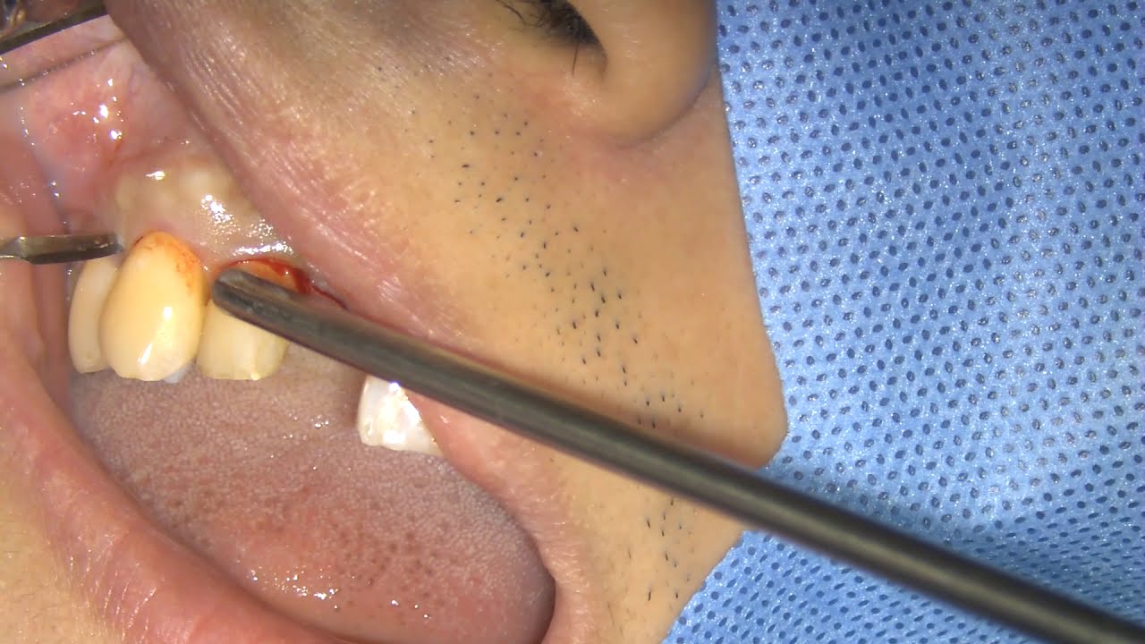 Guided implant Surgery with ridge augmentation - YouTube