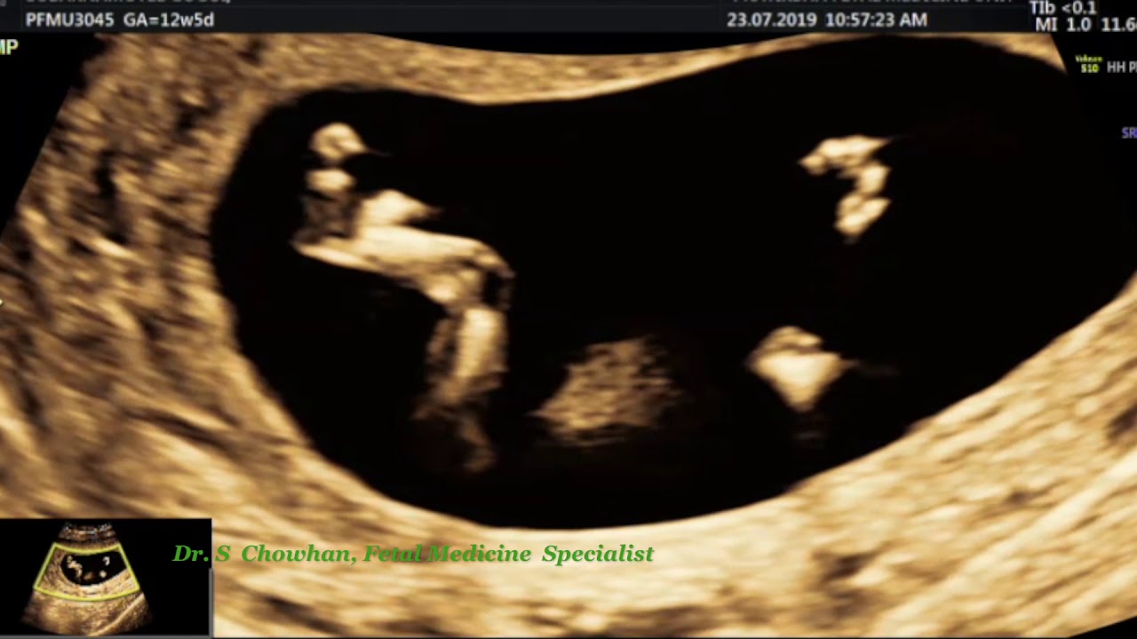 First trimester Scan/ Level 1 scan by Dr .S Chowhan, FetalMedicine ...