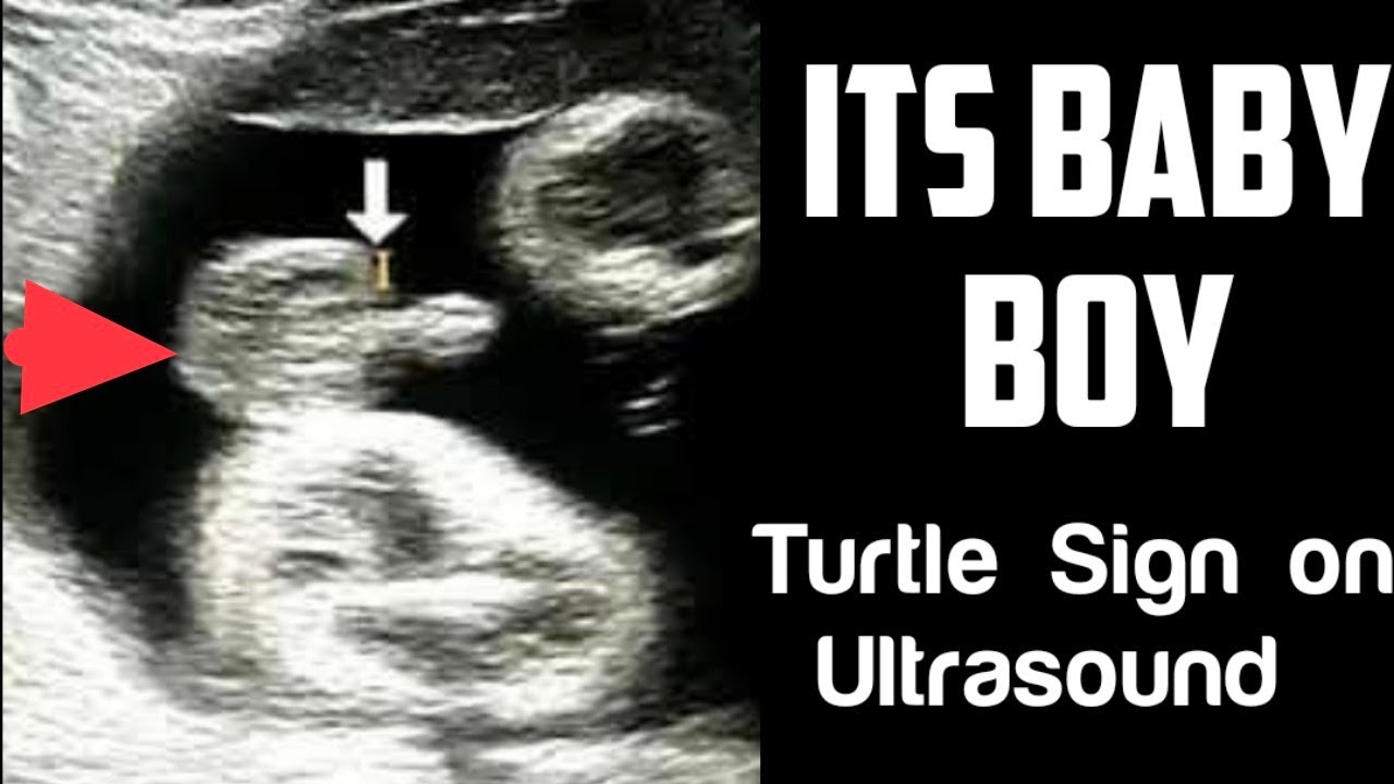 Turtle Sign Ultrasound