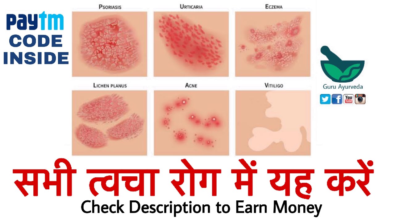 Treatment of Skin Diseases | त्वचा रोग का आसान घरेलू इलाज । Twacha Rog ...