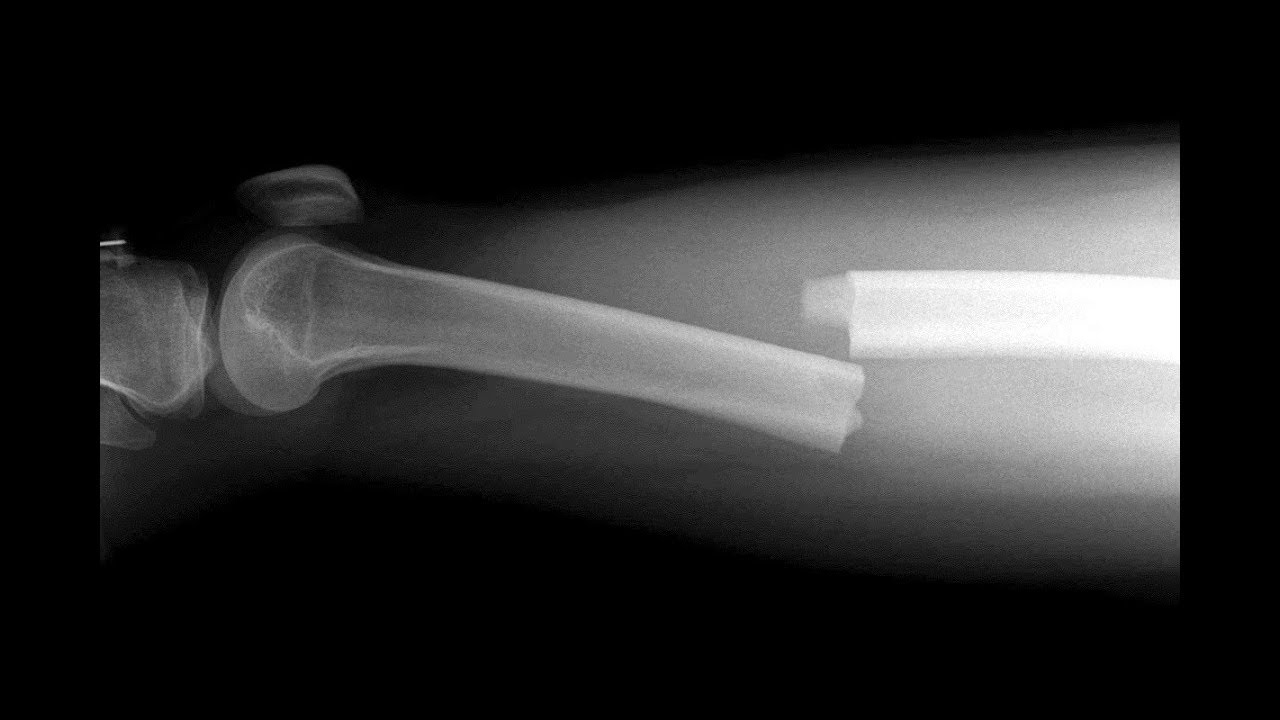 Femur Breaker, But your Ears Break as well. - YouTube