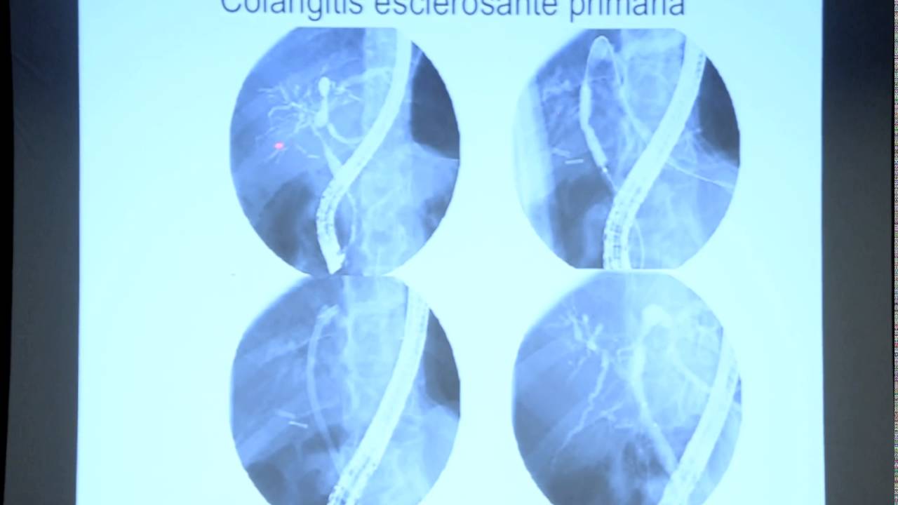 Estenosis de la vía biliar: Causas y manejo endoscópico - YouTube