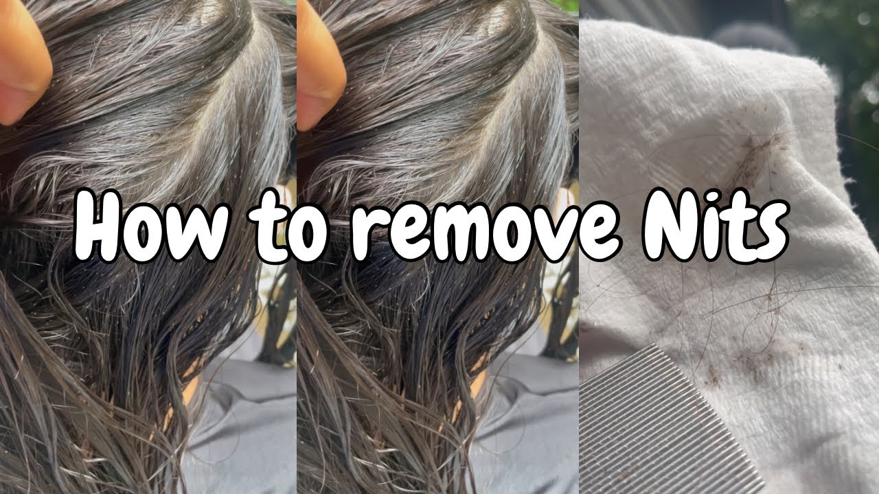 How to remove stubborn Nits l Nit Removal l Lice Eggs #explore #hair # ...