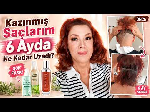 Dazlak Kafada, Doğru Bakımla ,Saç Nasıl Sağlıklı Ve Hızlı Uzar ?