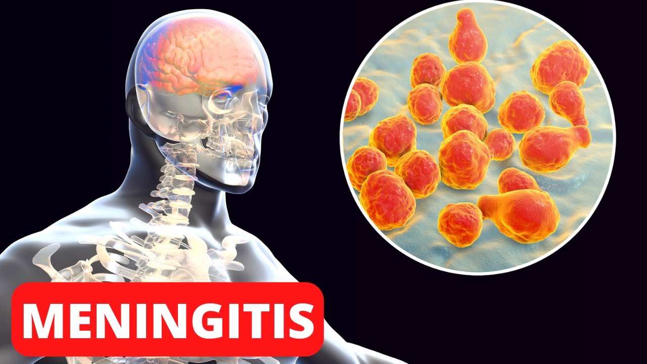 La MENINGITIS explicada: síntomas, tipos, causas, consecuencias ...