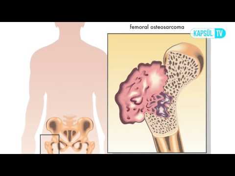 Osteosarkom Nasıl Tedavi Edilir?