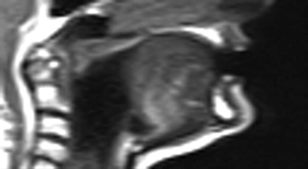 Ultrax MRI alveolar ejective - YouTube