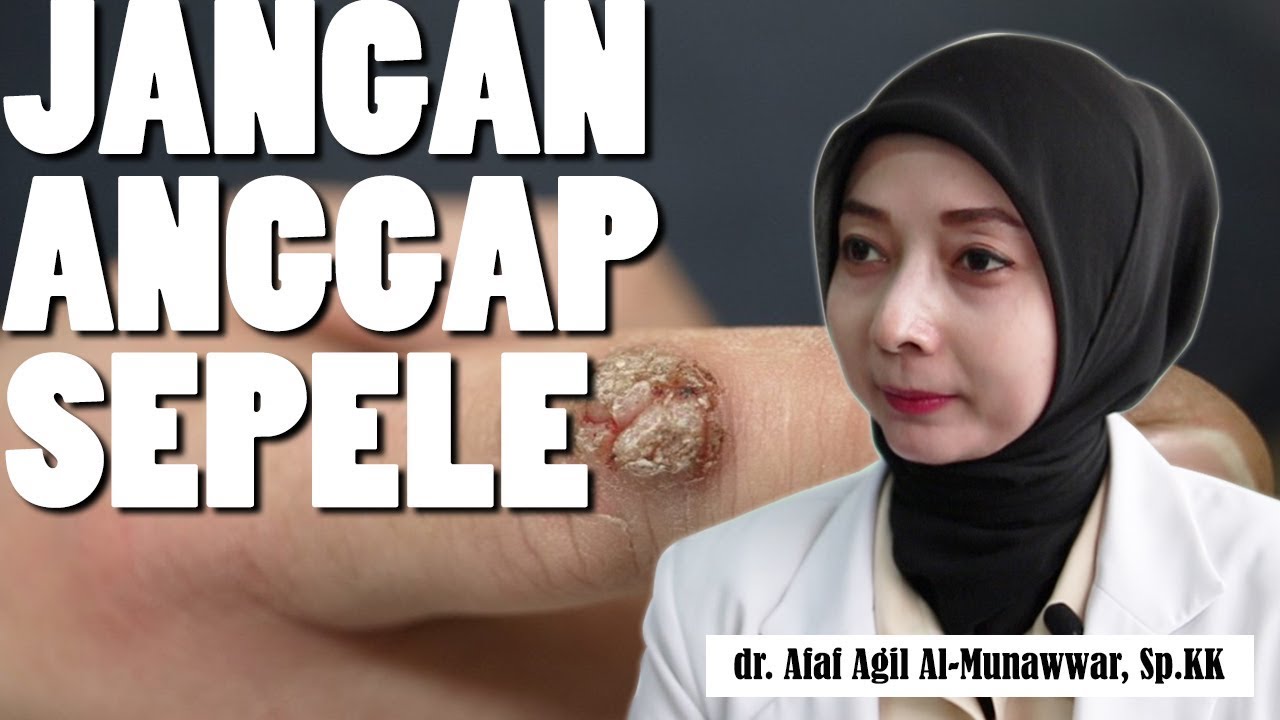 Kutil - Jenis - Penyebab - dan Mengatasinya - Wajib Waspada!! - YouTube
